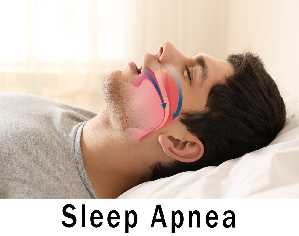Let Your Dentist Help You Stop Snoring | Summit Dental